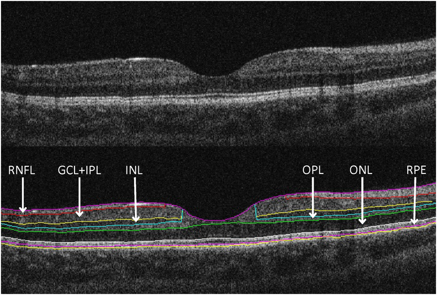 Estudio de OCT Macular – Visión Digna